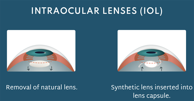 Ocumetics Bionic Lens Perfect Vision For Everyone At Bionic Contact